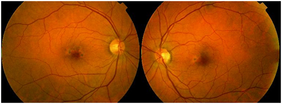 Retina Vitreo > Enfermedades hereditarias de la retina: Distrofias ...