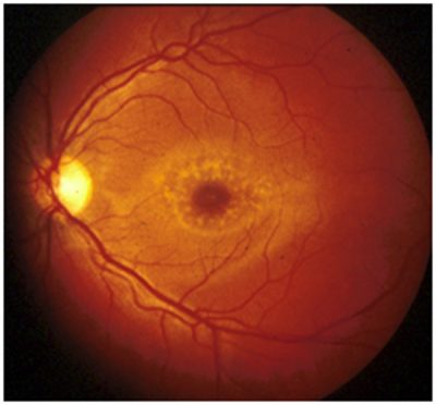Retina Vitreo > Enfermedades hereditarias de la retina: Distrofias ...